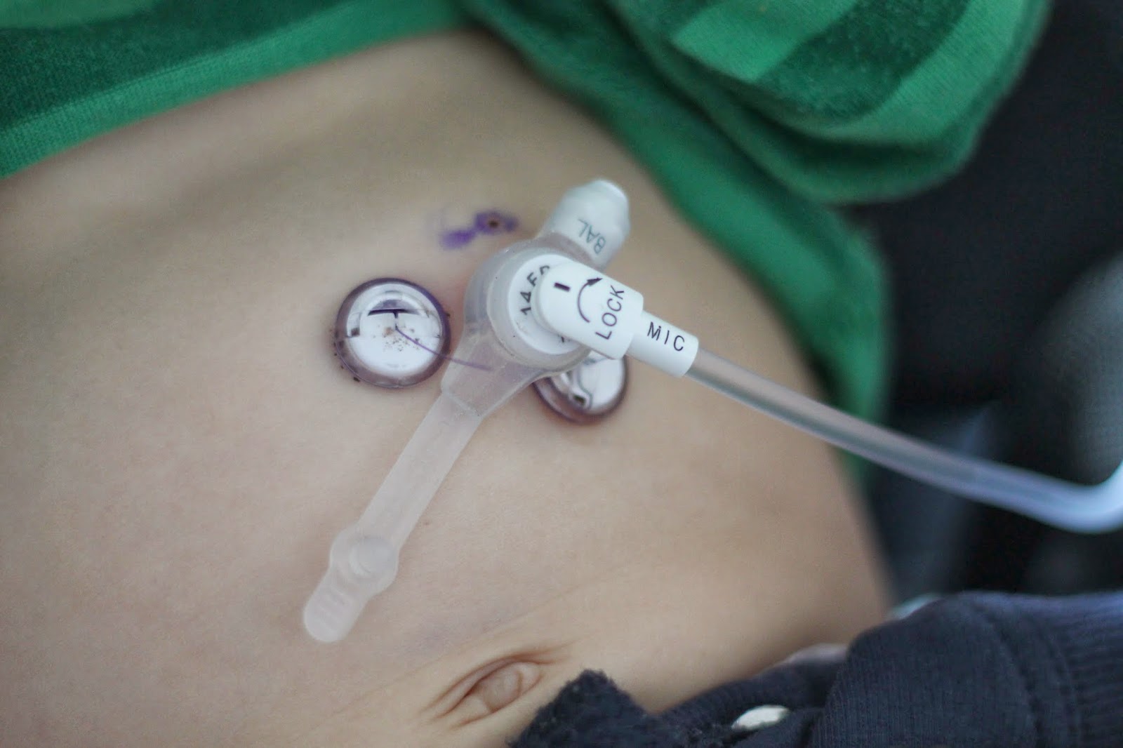 Aaronin tarina: PEG-nappi