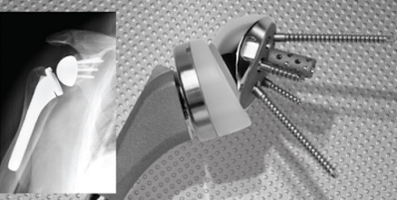 UW Shoulder and Elbow Academy: Reverse total shoulder - the value of ...