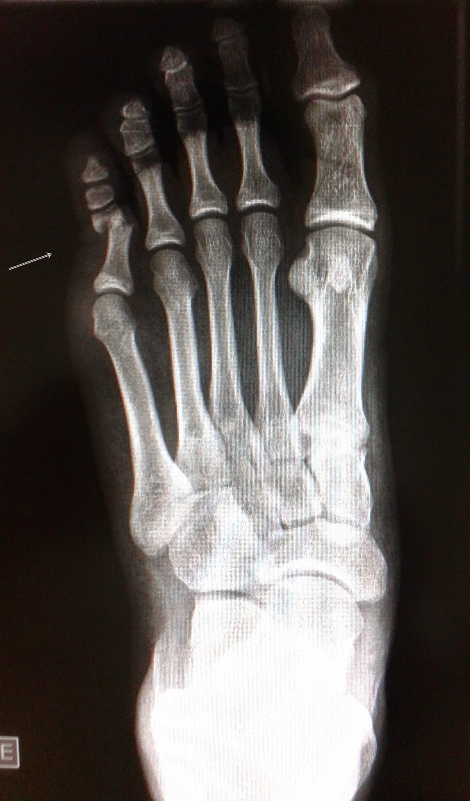 DICAS DE RADIOLOGIA: IMAGENS RADIOLÓGICAS - FRATURA DA FALANGE PROXIMAL ...