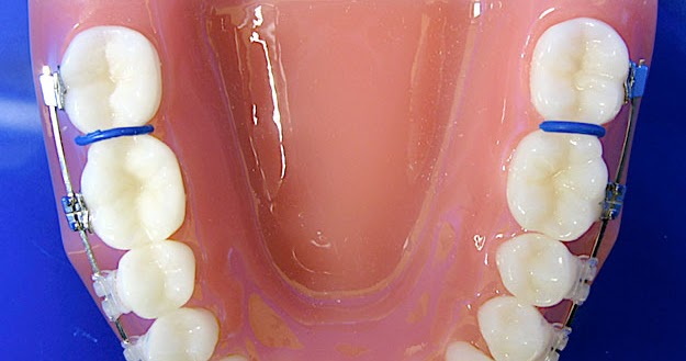 Burleson Orthodontics - Braces Invisalign Orthodontist Kansas City ...