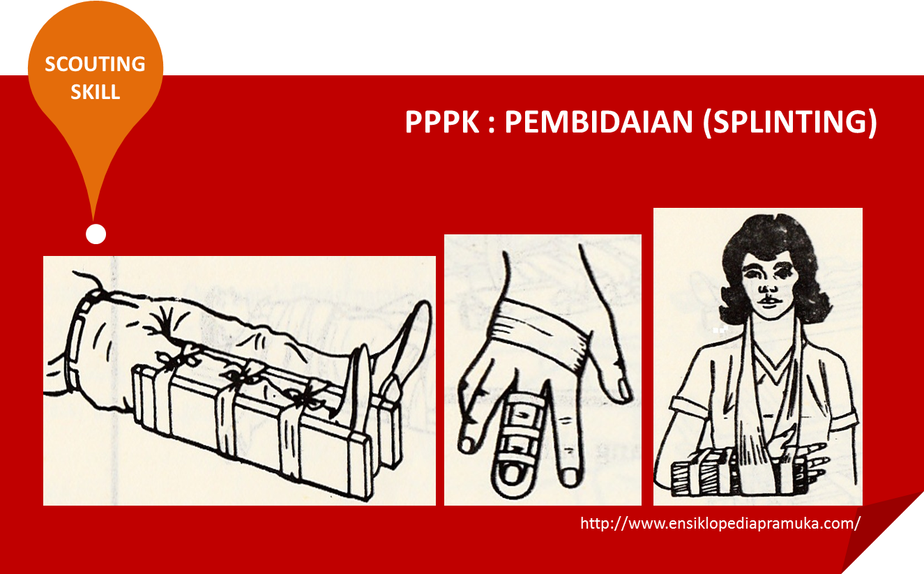 Ensiklopedia Pramuk: PPPK : Teknik Pembidaian (Splinting)