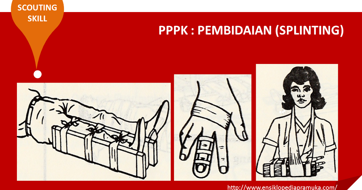 PPPK : Teknik Pembidaian (Splinting)