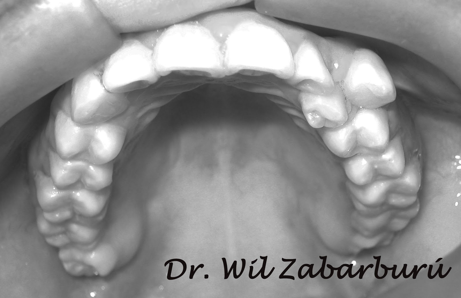 CLINICA DENTAL ASISTENCIAL: DIENTES SUPLEMENTARIOS, INCISIVO LATERAL