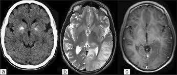Medical Treatment Pictures-for Better Understanding: MELAS Syndrome
