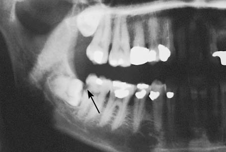 Impacted Mandibular 3rd Molar Classification, Complications ...