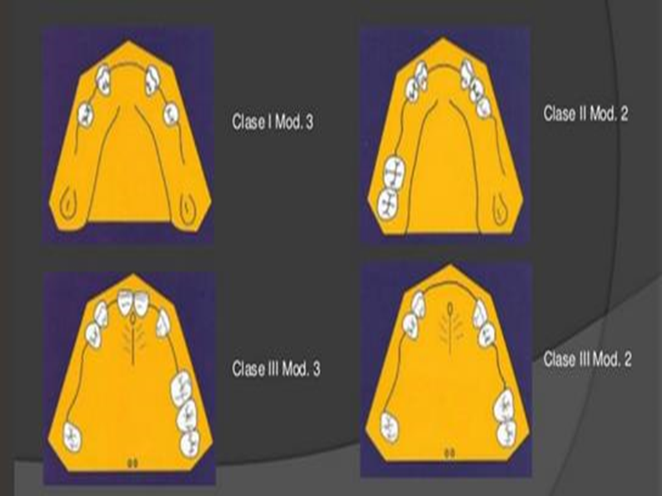 REHABILITACIÓN II : Clasificación Kennedy 1° Parte Unidad II y Video