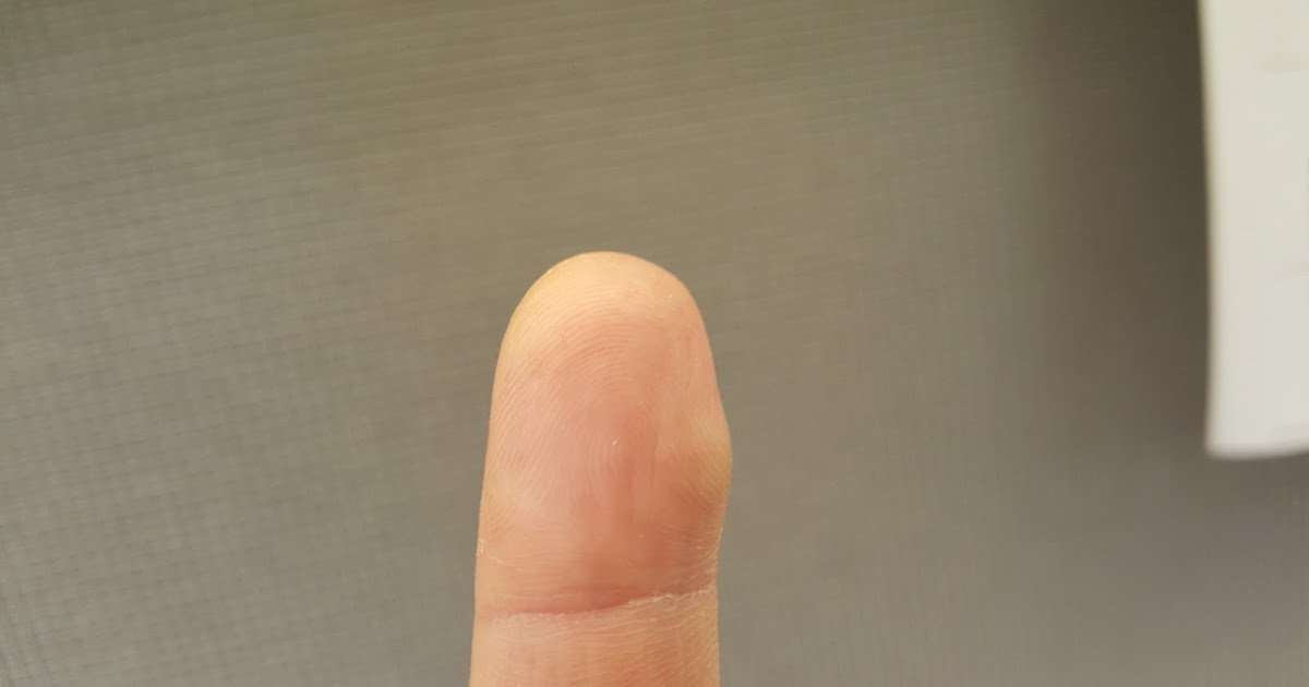 2017-05-17 (W) Index Finger Magnet Removal (Content warning)