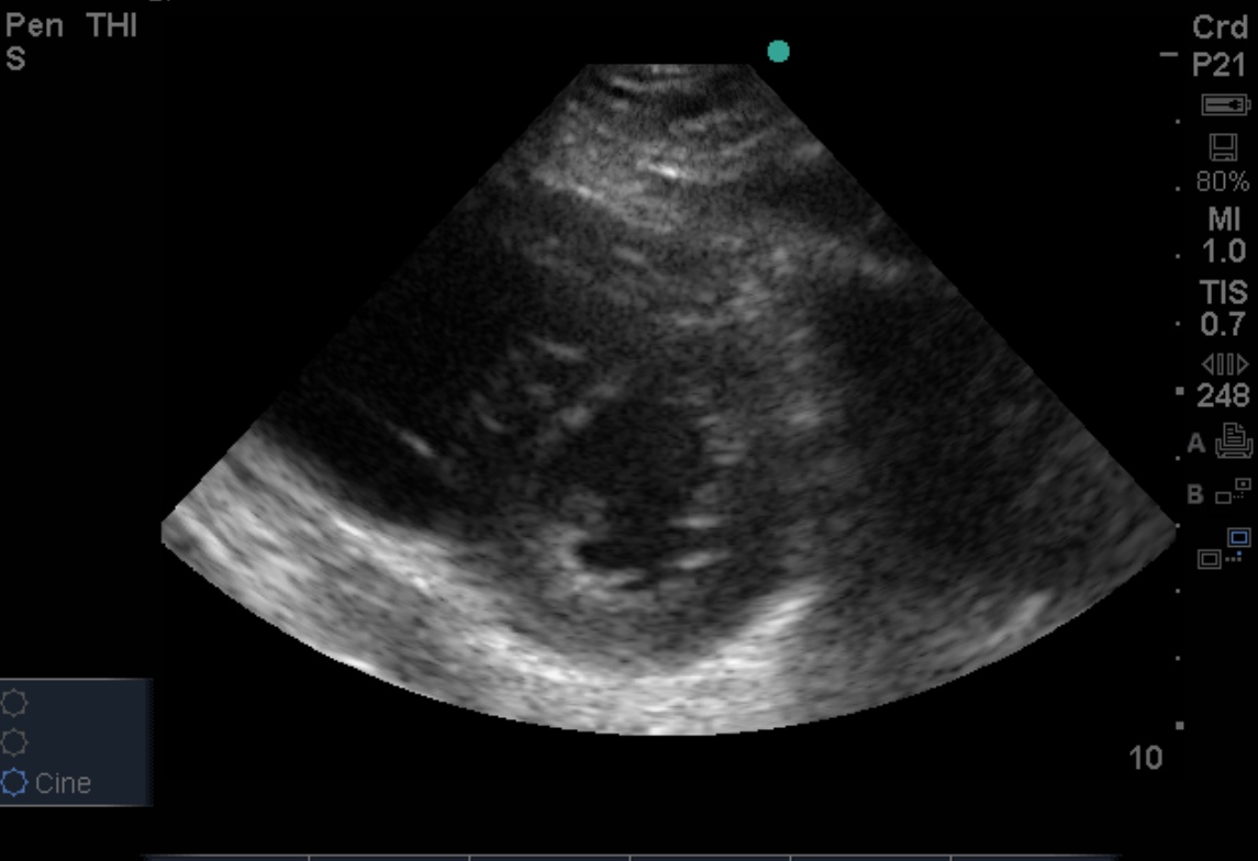 Dr. Smith's ECG Blog: Answer: pulmonary embolism. Now another, with ...