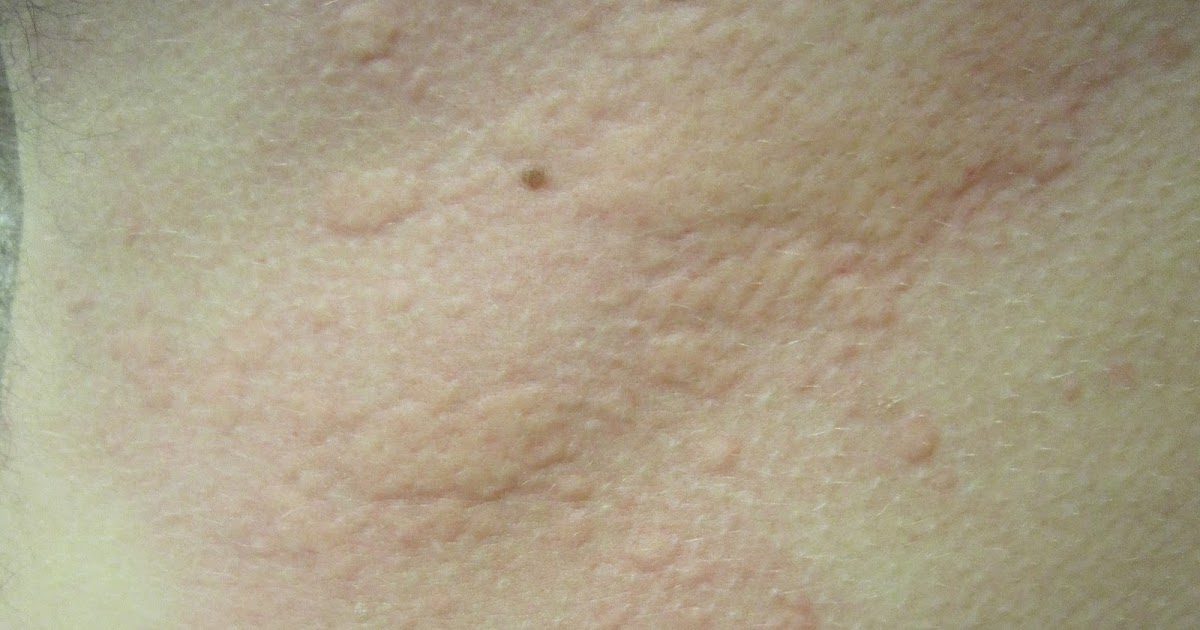 HIVES ~ health mania