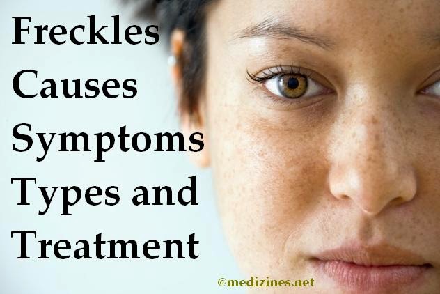 Freckles – Causes, Symptoms, Types and Treatment