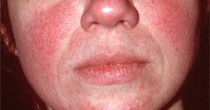 Strategies On How to Prevent the Niacin Flush | Life and Supplementation