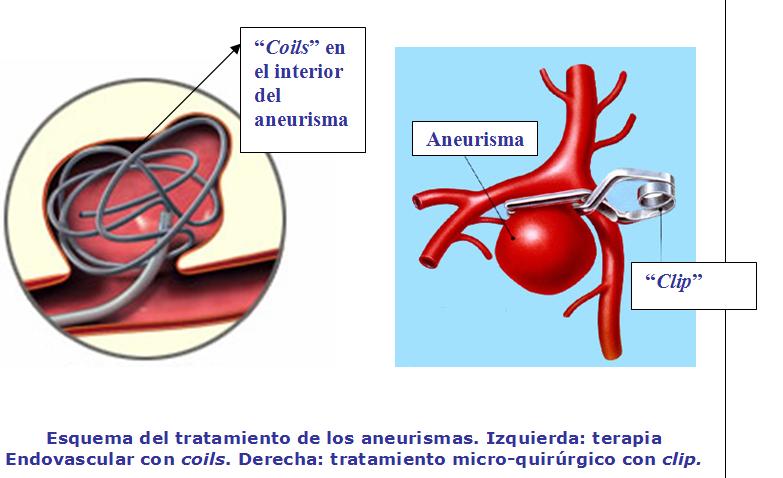 Aneurisma Cerebral, Asesino Silencioso: Tratamiento