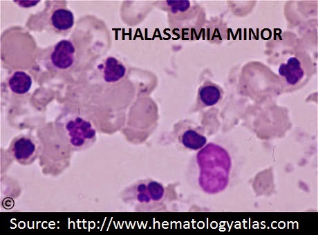 Lab Atlas: Thalassemia Minor
