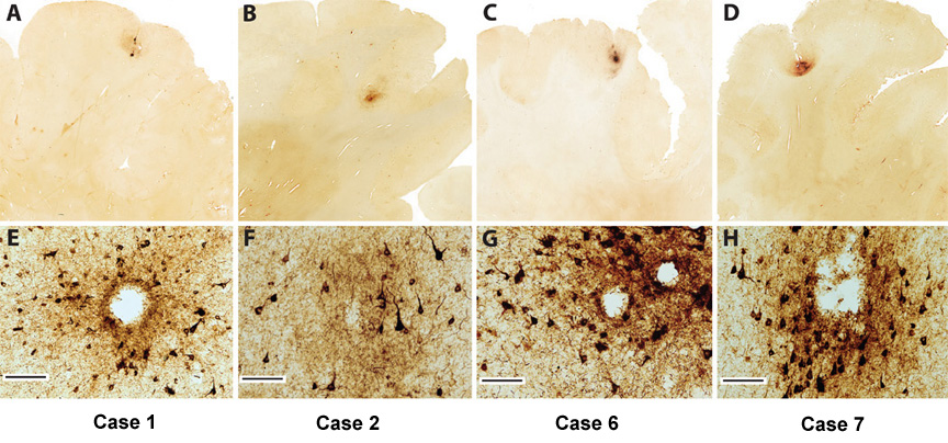 The Neurocritic: Blast Wave Injury and Chronic Traumatic Encephalopathy ...