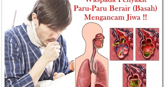Obat tb paru paru Basah bengkak tuberkulosis