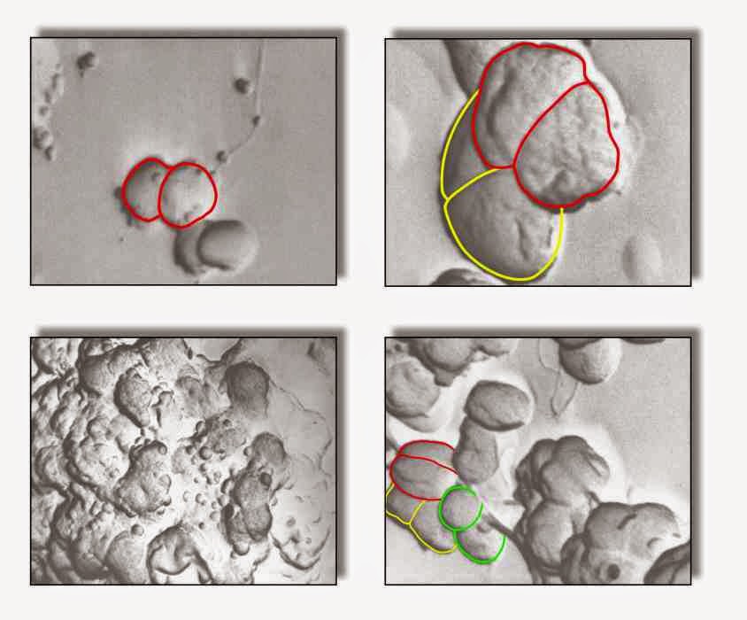 gonorrhea infection | causes | transmission ~ infectious diseases