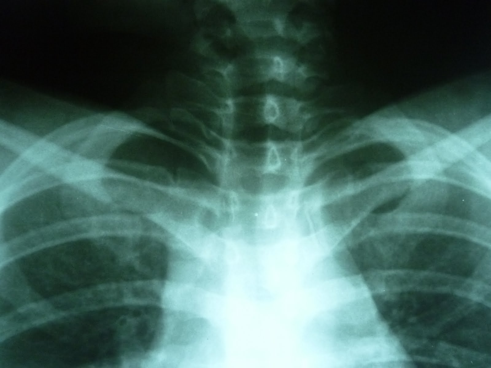 Rx011: Proyección Esternón