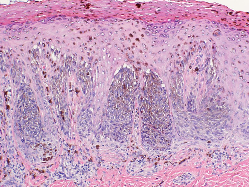 VIRTUAL GRAND ROUNDS IN DERMATOLOGY 2.0: Toddler with Black Nevus