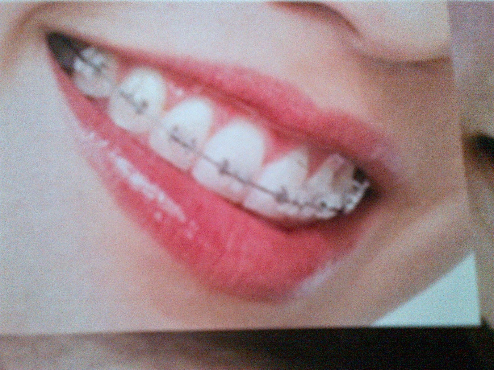 DOKTER GIGI BALI PERMATA DENTAL : BEHEL | BRACKET | KAWAT GIGI ...