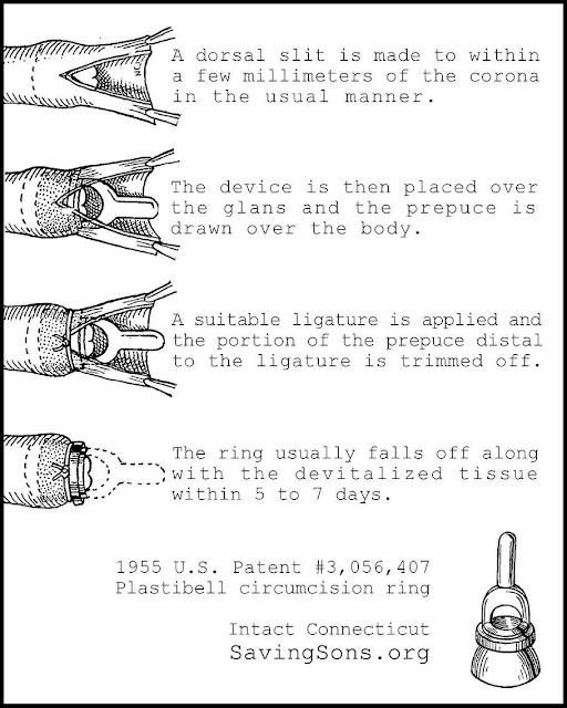 peaceful parenting: Plastibell Infant Circumcision