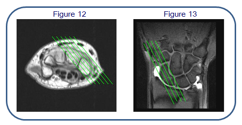 MRI Protocols: Scaphoid MRI coronal and sagital reference lines