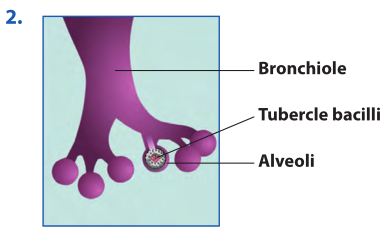Tuberculosis (TB): Mechanism