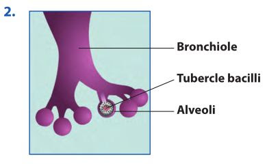 Tuberculosis (TB): Mechanism