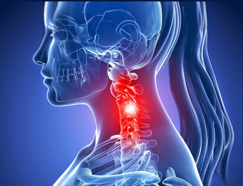 CLINICA FISIOSAS: LATIGAZO CERVICAL