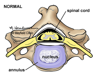 How to Treat Cervical Disc Disease : Controlling Neck Pain at Home - GG ...