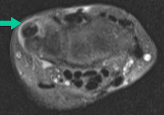 mricases: Extensor Carpi Ulnaris Tenosynovitis