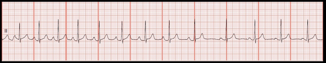 Practice EKG Rhythm Strips 136