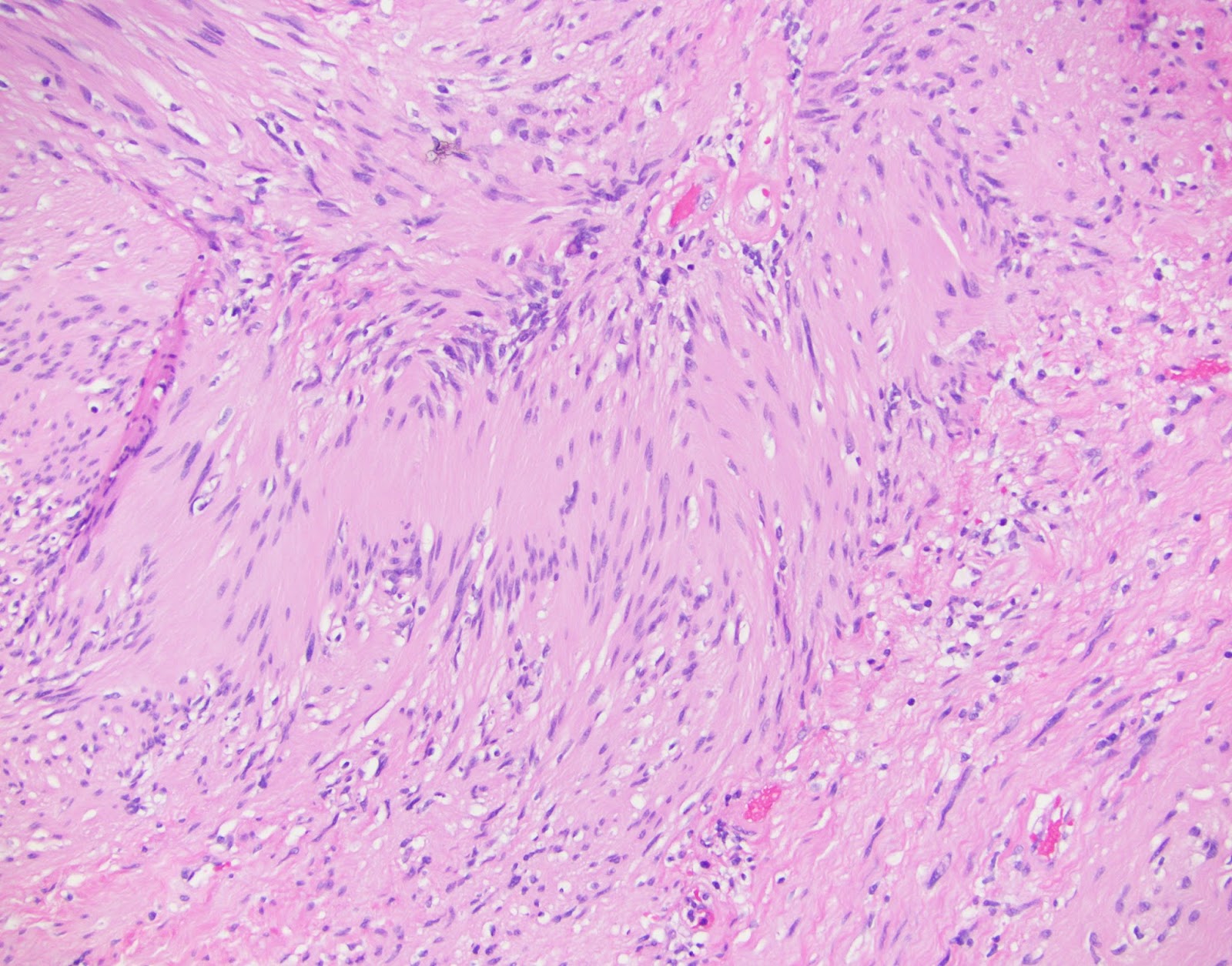 neuropathology blog: Verocay body in a brachial plexus Schwannoma