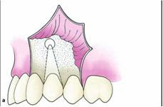 dental: Flap Design on oral surgery