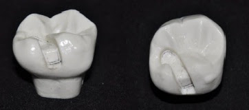 Prateleira do Dentista: DENTÍSTICA I: PREPARO CAVITÁRIO CLASSE I COMPOSTA