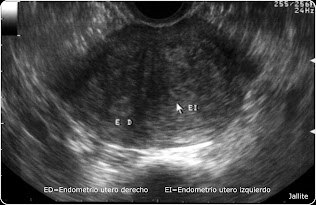 Útero Doble o Didelfos