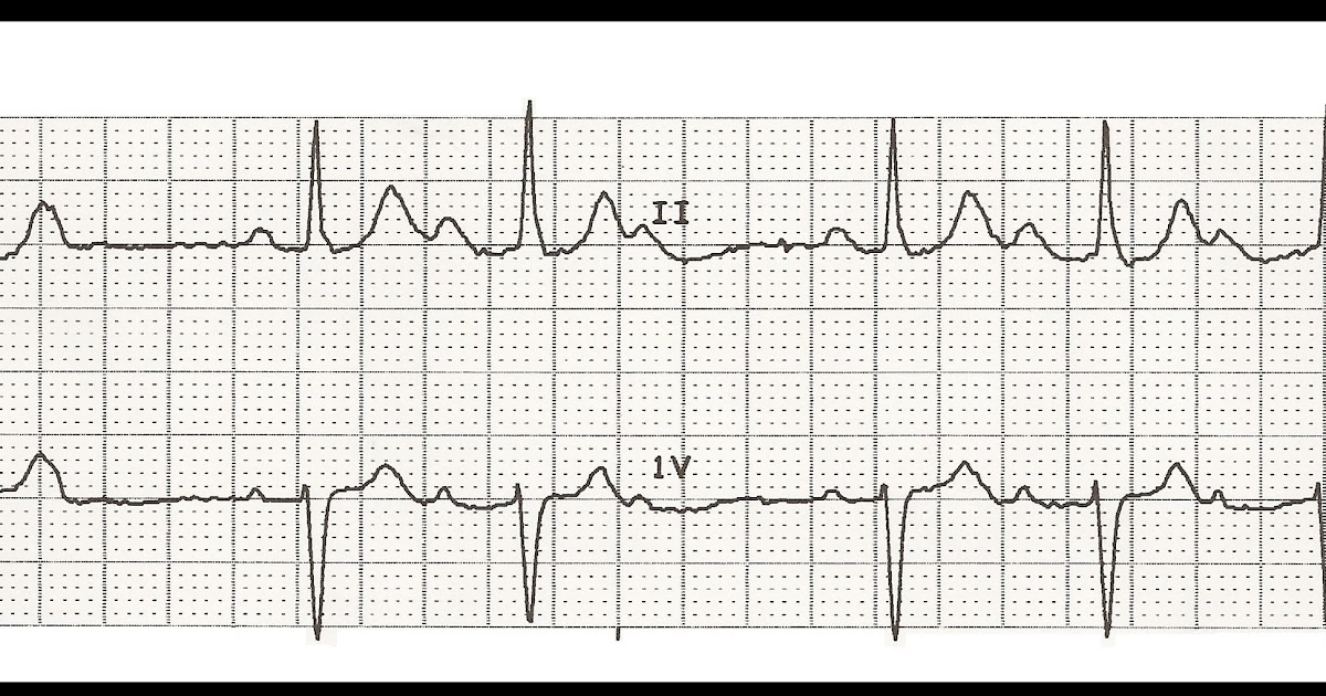 EKG Quiz 350