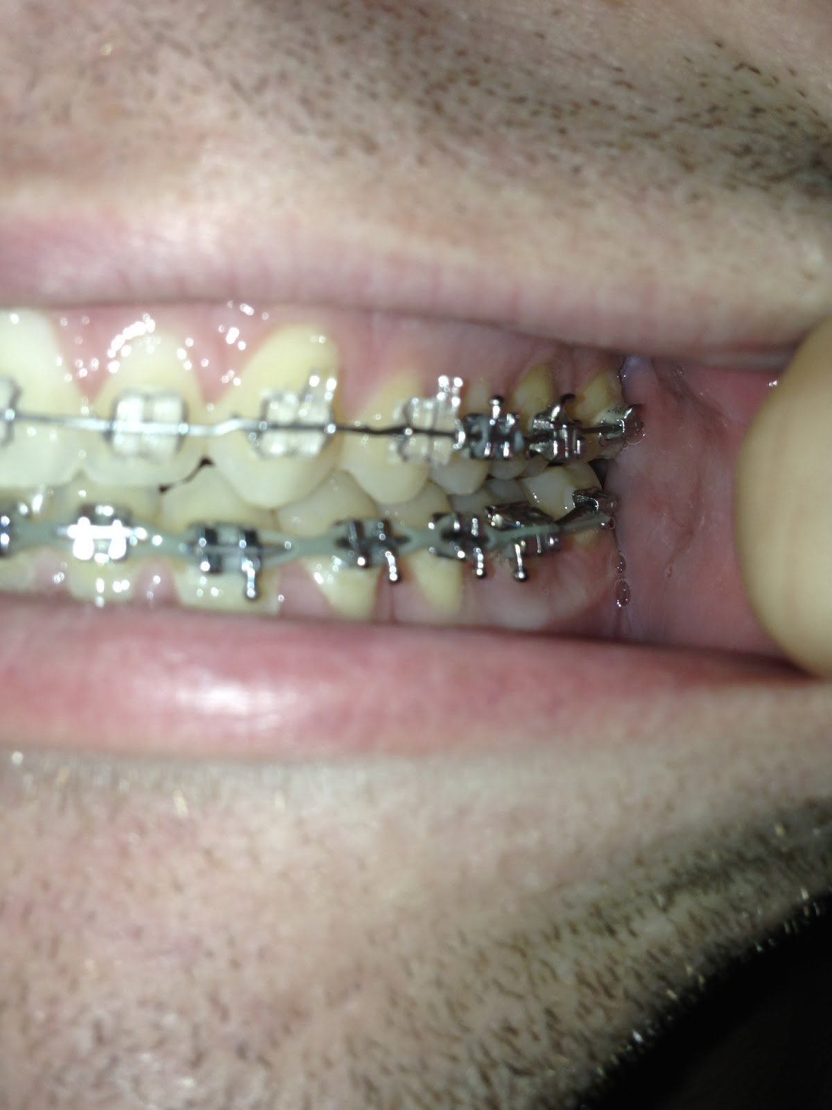 Braces/Open Bite Surgery