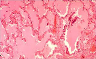 DESTINO MEDICO: MICROSCOPIO VIRTUAL PATOLOGIA PULMONAR - EDEMA PULMONAR