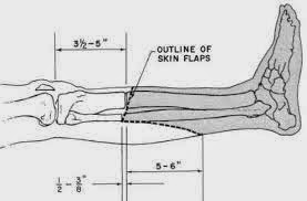 Medical Treatment Pictures-for Better Understanding: Below the knee ...