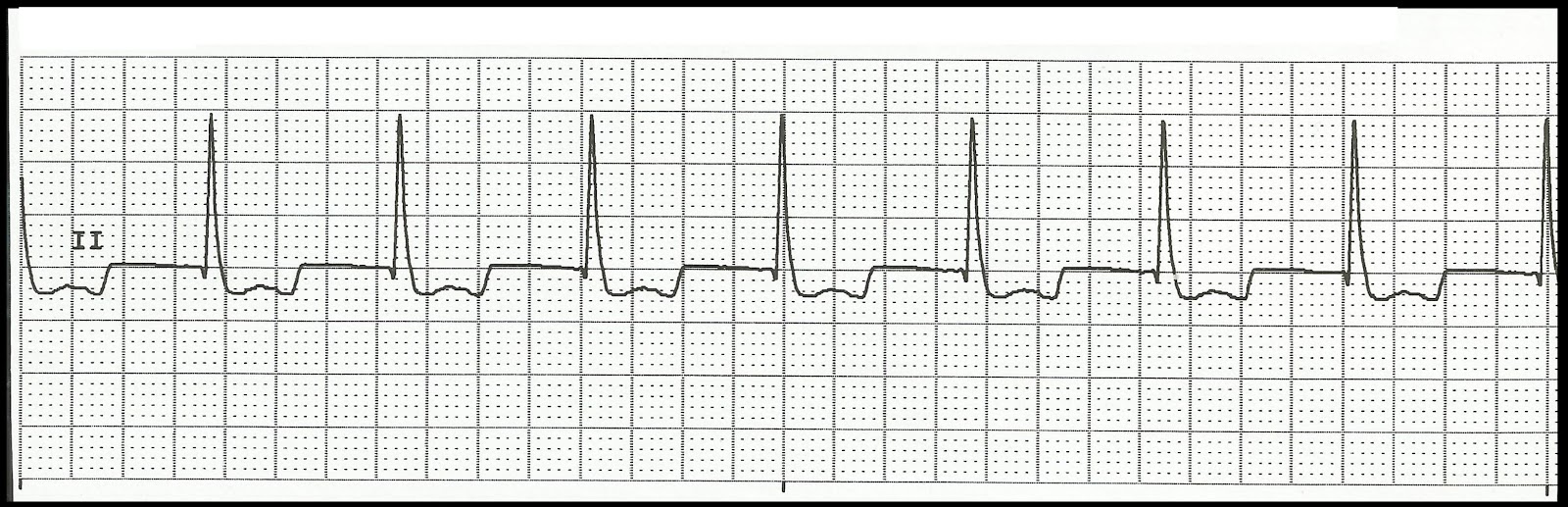 Float Nurse: EKG Rhythm Strip Quiz 98: Junctional rhythms