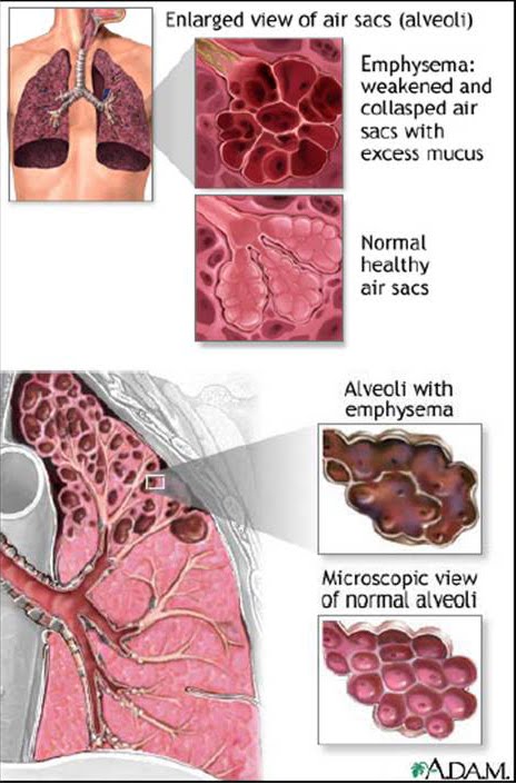 Dokter Okachan: EMFISEMA SUBKUTAN