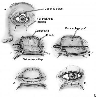 Eyelid Surgery by Prof Dr CN CHUA 蔡鐘能: Doc, can Anything be Done about ...