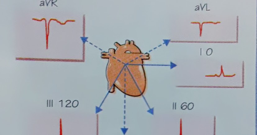 Acute Myocardial Infarction (AMI), Etiology, Pathophysiology, Causes ...