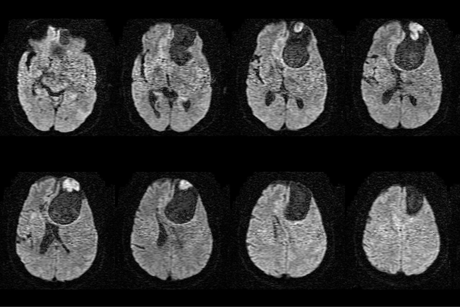 Dr Balaji Anvekar FRCR: Frontal SOL, Guess Histopathology