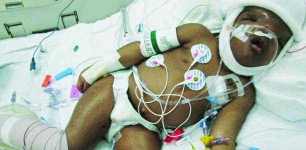Welcome To iCONTACT CENTRE : Amazing! Nigerian Baby Without Skull Gets ...