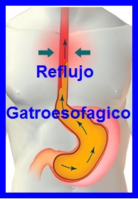 SALUD GASTRICA: REFLUJO GASTROESOFAGICO, CAUSAS, SÍNTOMAS Y TRATAMIENTO