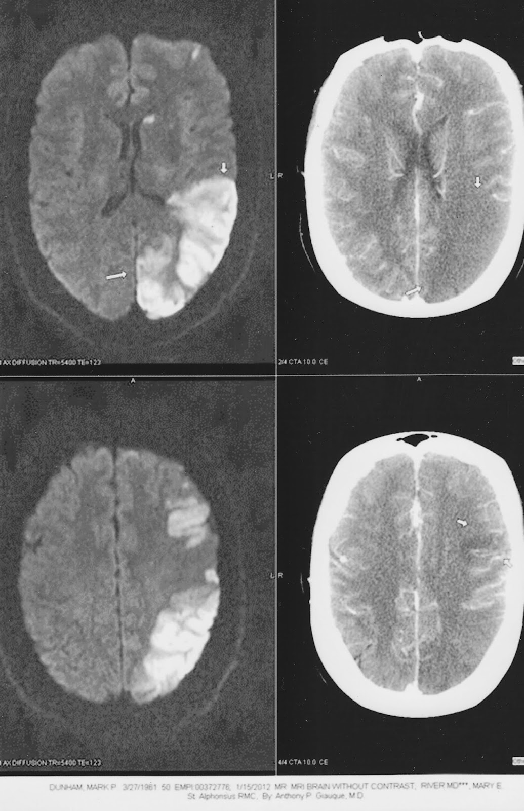 Second anniversary of my massive stroke is today, January 13.