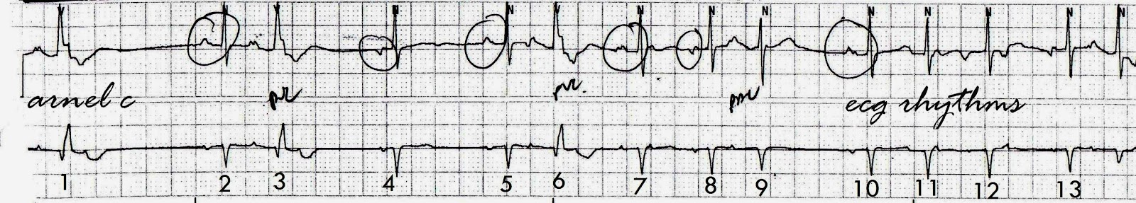 ECG Channel: Multifocal Atrial Arrhythmia