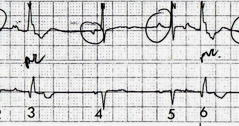 ECG Channel: Multifocal Atrial Arrhythmia