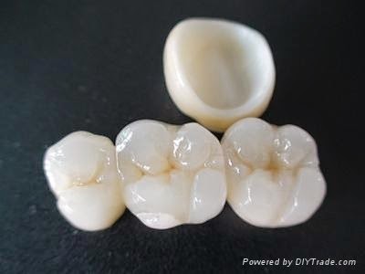 Ahmedabad dentist: FULL CERAMIC VENEER CROWN
